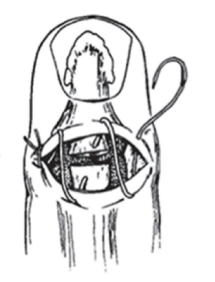 Open Extensor Tendon Repair in the ED — BROWN EMERGENCY MEDICINE BLOG