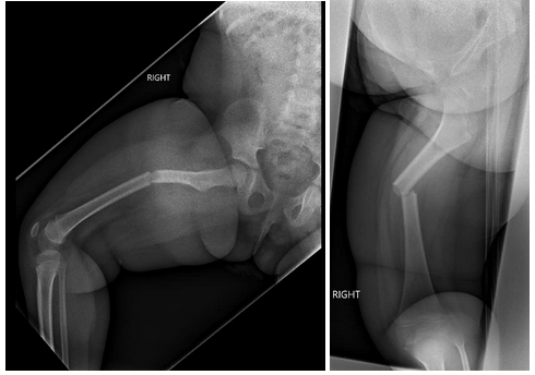 Emergency Department Application of J-splints to Temporize Pediatric ...