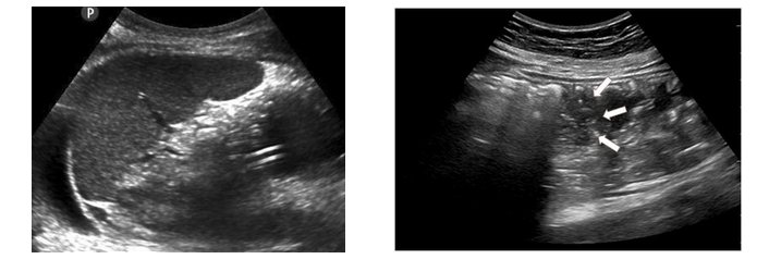 Ultrasound for the Confirmation of Nasogastric Tube Placement in the ...