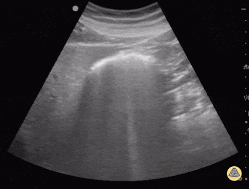 Ultrasound for the Confirmation of Nasogastric Tube Placement in the ...