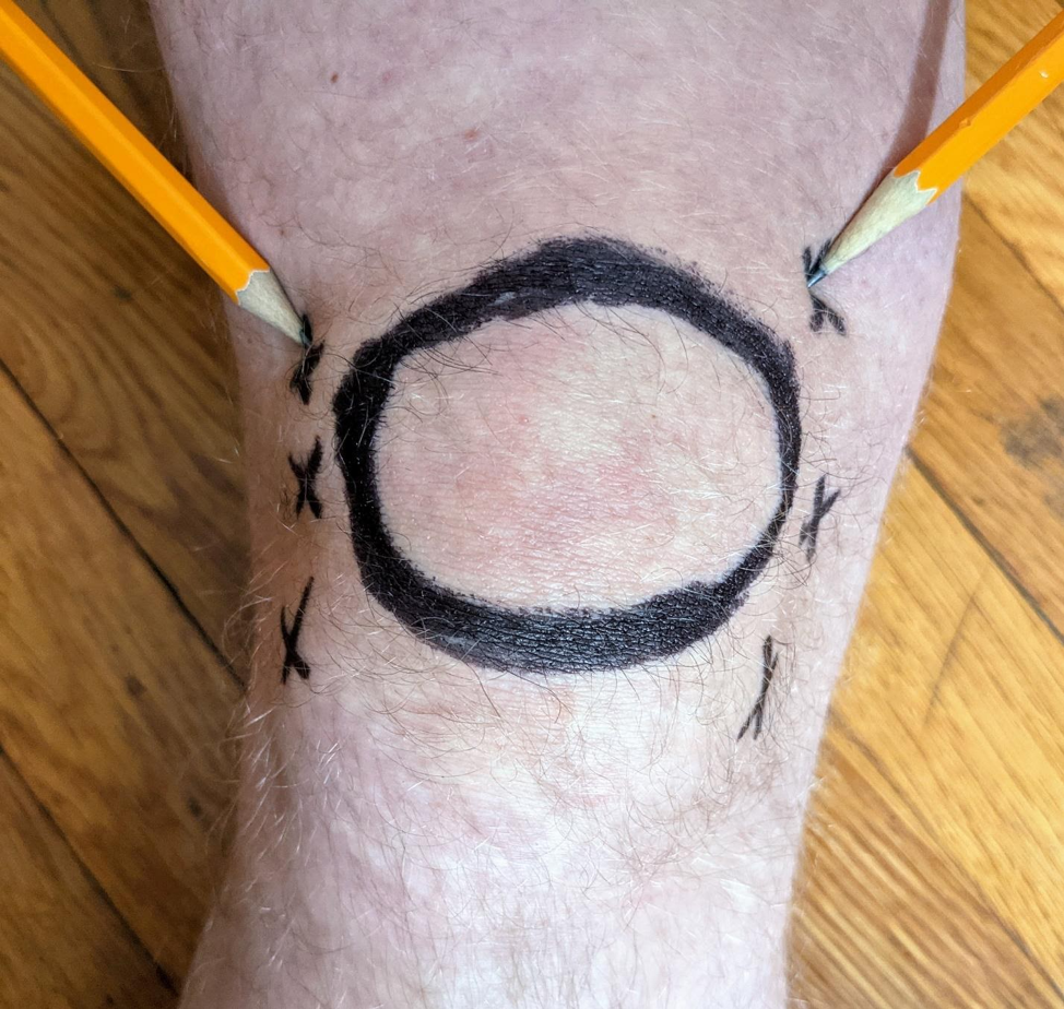 Basics of Knee Aspiration — BROWN EMERGENCY MEDICINE BLOG