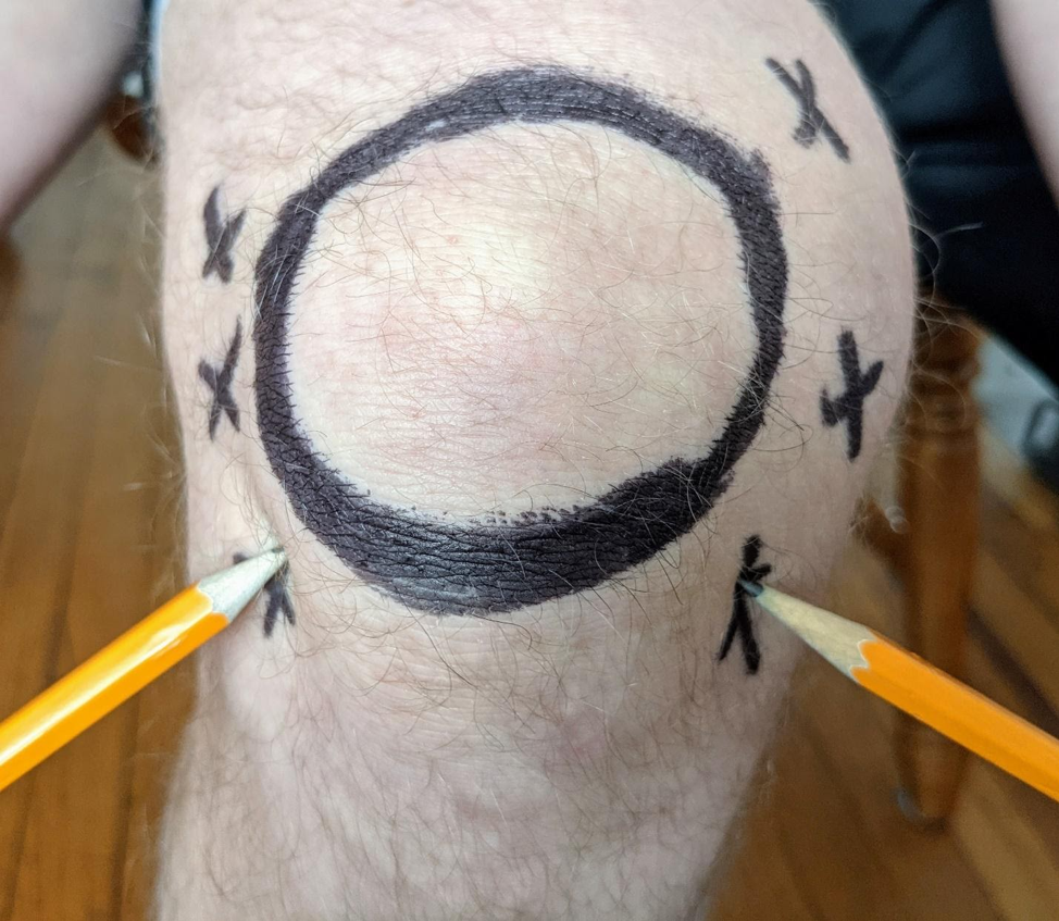 Basics of Knee Aspiration — BROWN EMERGENCY MEDICINE BLOG
