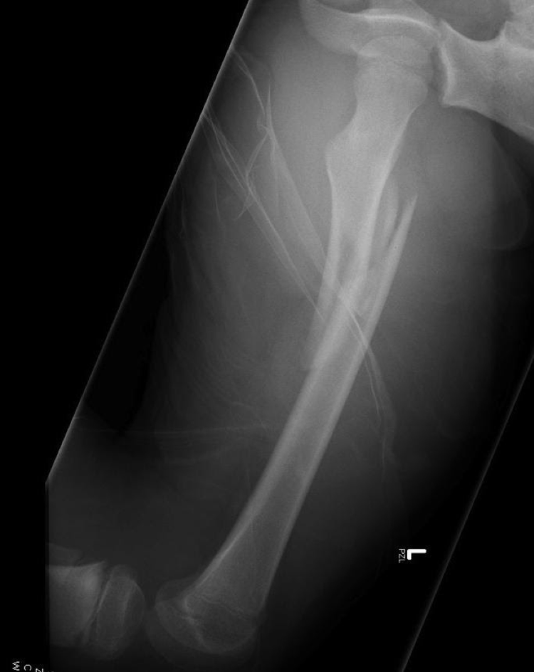 Pavlik Harness For Femur Fracture