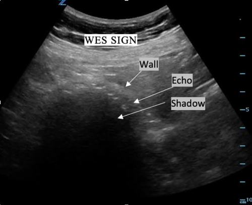 Gallbladder Ultrasound