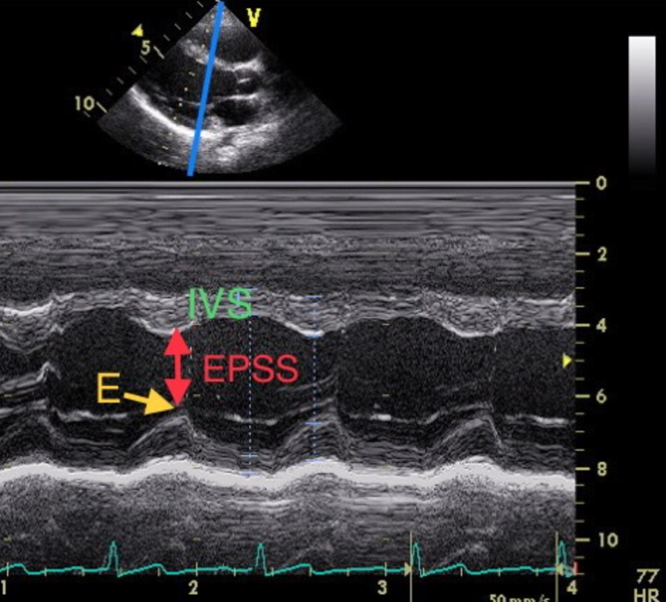 Using POCUS for Ejection Fraction Estimation — BROWN EMERGENCY MEDICINE ...