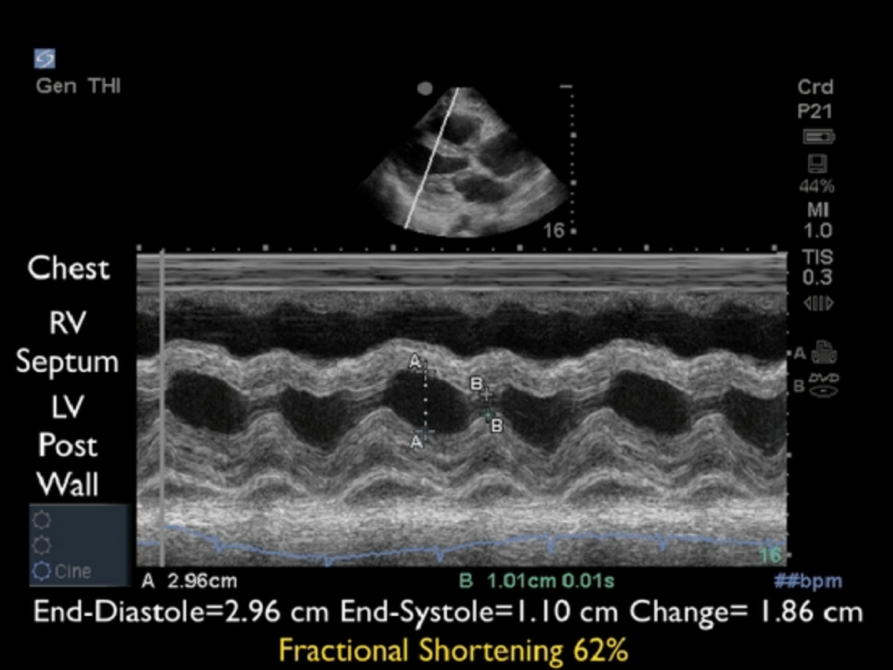 Using POCUS for Ejection Fraction Estimation — BROWN EMERGENCY MEDICINE ...