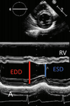 Using POCUS for Ejection Fraction Estimation — BROWN EMERGENCY MEDICINE ...