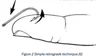 Fishhook Injuries — BROWN EMERGENCY MEDICINE