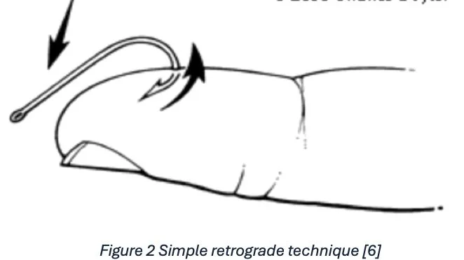 Fishhook Injuries — BROWN EMERGENCY MEDICINE