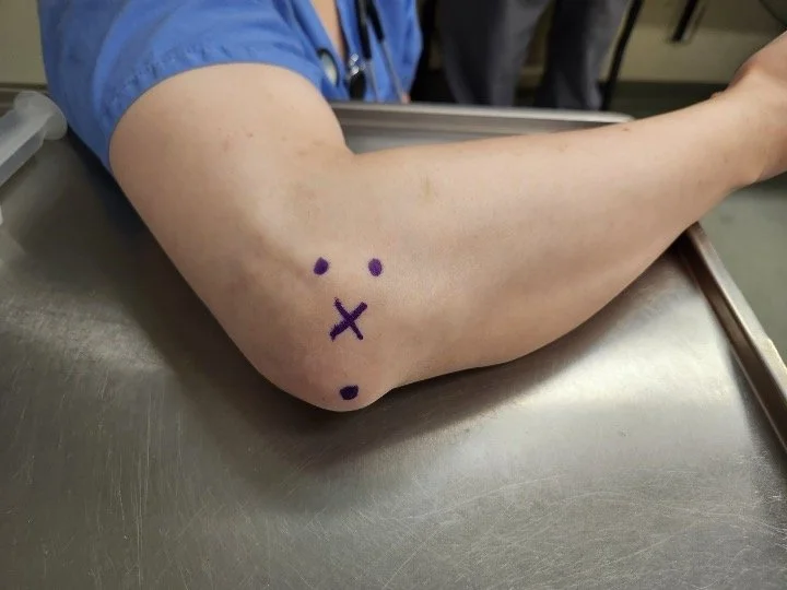 Not so Funny Bone - Traumatic Arthrotomy of the Elbow — BROWN EMERGENCY ...