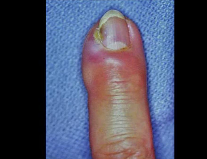 Acute Paronychia: The Dark Side of Nail-biting — BROWN EMERGENCY ...