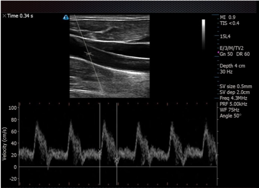Volume Assessment Using POCUS in the Emergency Department — BROWN ...