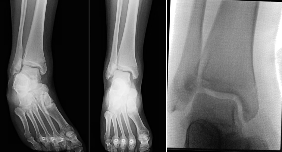 A Review of Adolescent Triplane Fractures of the Distal Tibia — BROWN ...