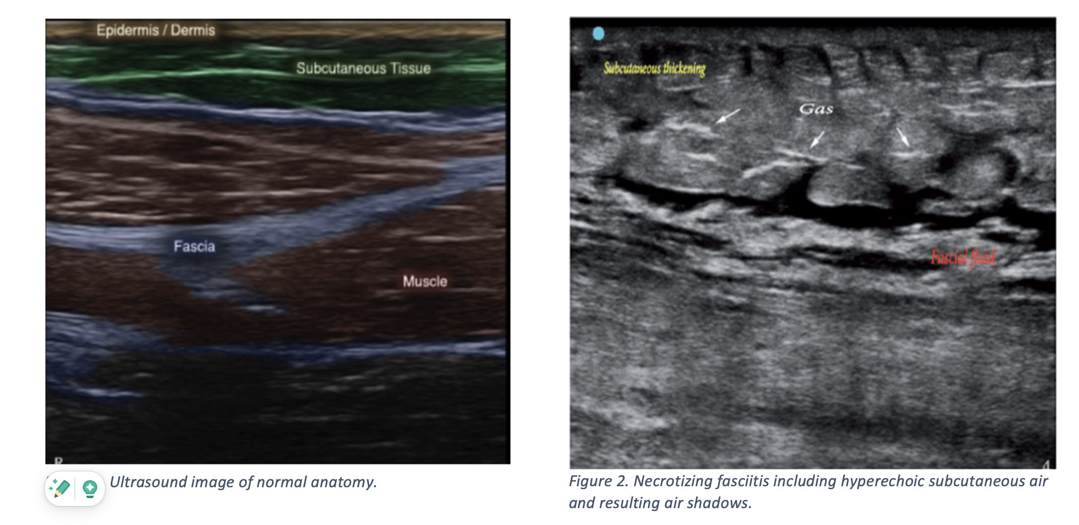 BrownSound POCUS for Diagnosis of Necrotizing Fasciitis — BROWN ...