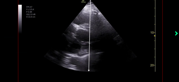 EPSS As a Proxy for Ejection Fraction — BROWN EMERGENCY MEDICINE BLOG