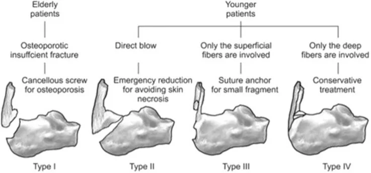 Will Achilles Heal? When Calcaneal Fractures Are Surgical Emergencies ...