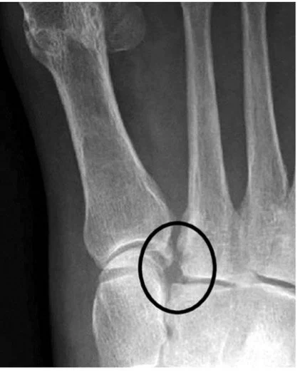 A Hop, Skip and a Jump: Lisfranc Injuries in the Emergency Department ...