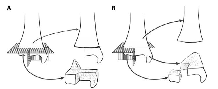 A Review of Adolescent Triplane Fractures of the Distal Tibia — BROWN ...
