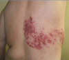 Disseminated Zoster in an Immunocompromised Patient — BROWN EMERGENCY ...