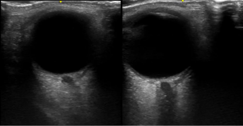 Retrobulbar Hematoma: When To Cut? — BROWN EMERGENCY MEDICINE BLOG