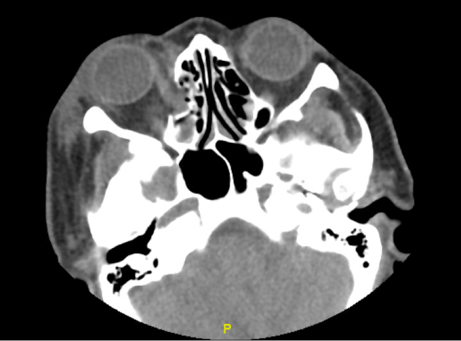 Retrobulbar Hematoma: When To Cut? — BROWN EMERGENCY MEDICINE BLOG