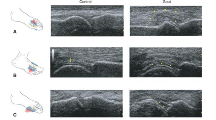 A Flare in the ED: Using Ultrasound to Diagnose Gout — BROWN EMERGENCY ...