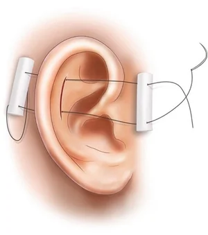 FAST TRACK: Auricular Hematomas — BROWN EMERGENCY MEDICINE BLOG