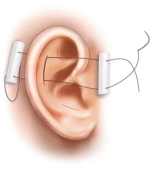 FAST TRACK: Auricular Hematomas — BROWN EMERGENCY MEDICINE BLOG