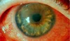 FAST TRACK: Corneal Abrasions — BROWN EMERGENCY MEDICINE BLOG