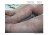 Recognizing the Differential Diagnoses for Erythema Multiforme — BROWN ...