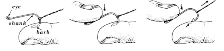 Fishhook Injuries — BROWN EMERGENCY MEDICINE