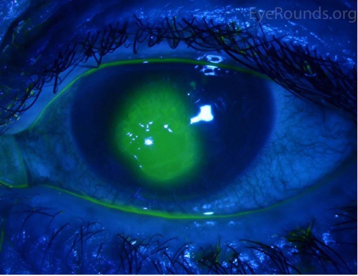 FAST TRACK: Corneal Abrasions — BROWN EMERGENCY MEDICINE BLOG