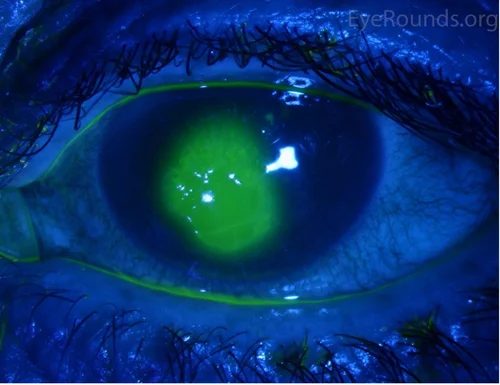 FAST TRACK: Corneal Abrasions — BROWN EMERGENCY MEDICINE BLOG