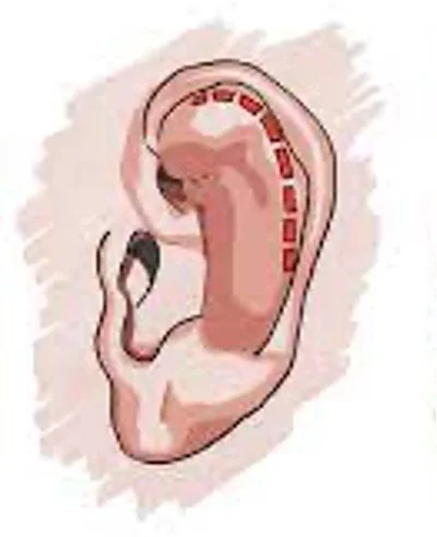 FAST TRACK: Auricular Hematomas — BROWN EMERGENCY MEDICINE BLOG