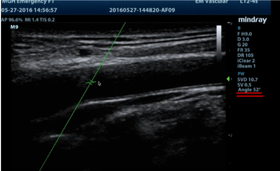 Volume Assessment Using POCUS in the Emergency Department — BROWN ...