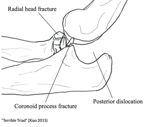 Elbow Dislocations — BROWN EMERGENCY MEDICINE