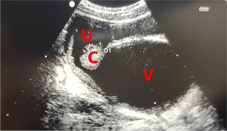 Masquerading As a Simple Cystitis: Hematocolpos — BROWN EMERGENCY ...