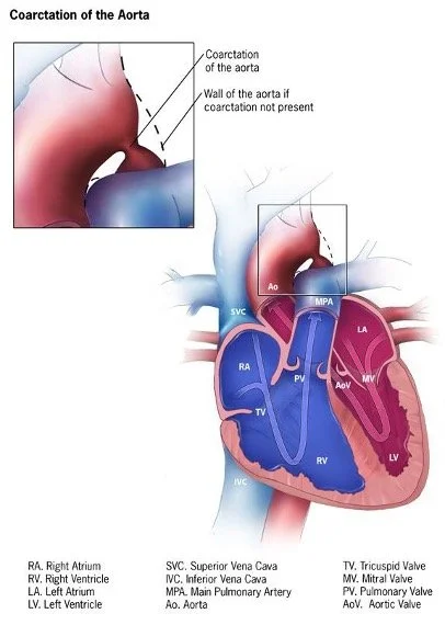 Abnormal Pulses and Pulse Oximetry: Diagnosis of A Critical Congenital ...