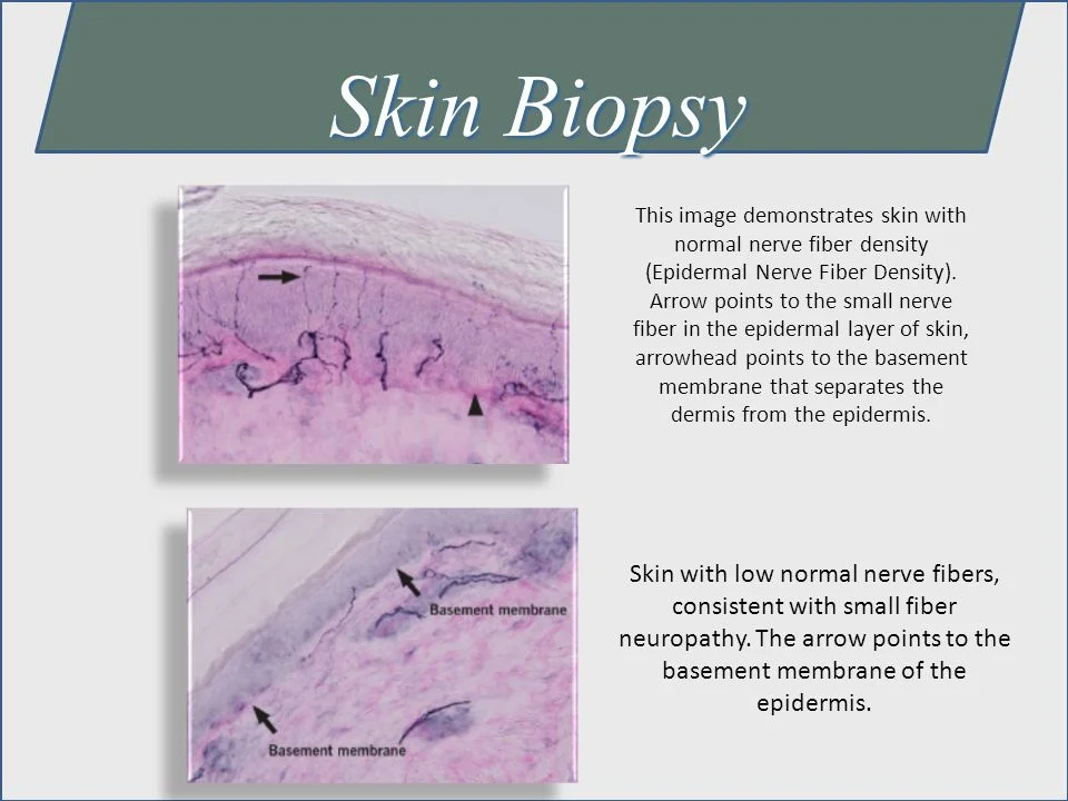 ENFD - Skin Punch Biopsy testing for Small Fiber Neuropathy — MedWORX ...