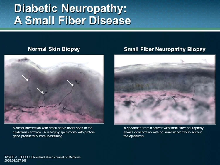 ENFD - Skin Punch Biopsy testing for Small Fiber Neuropathy — MedWORX ...