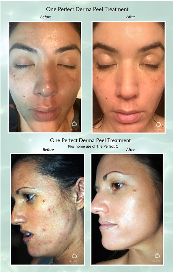 The Perfect Peel: Beverly Hills : $200+UP — ALCHEMY MARIN