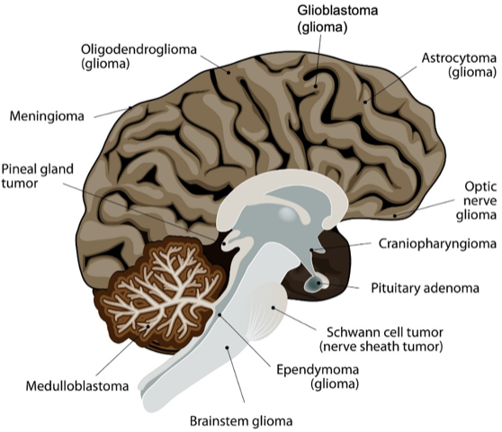 anaplastic astrocytoma — Orbus Therapeutics