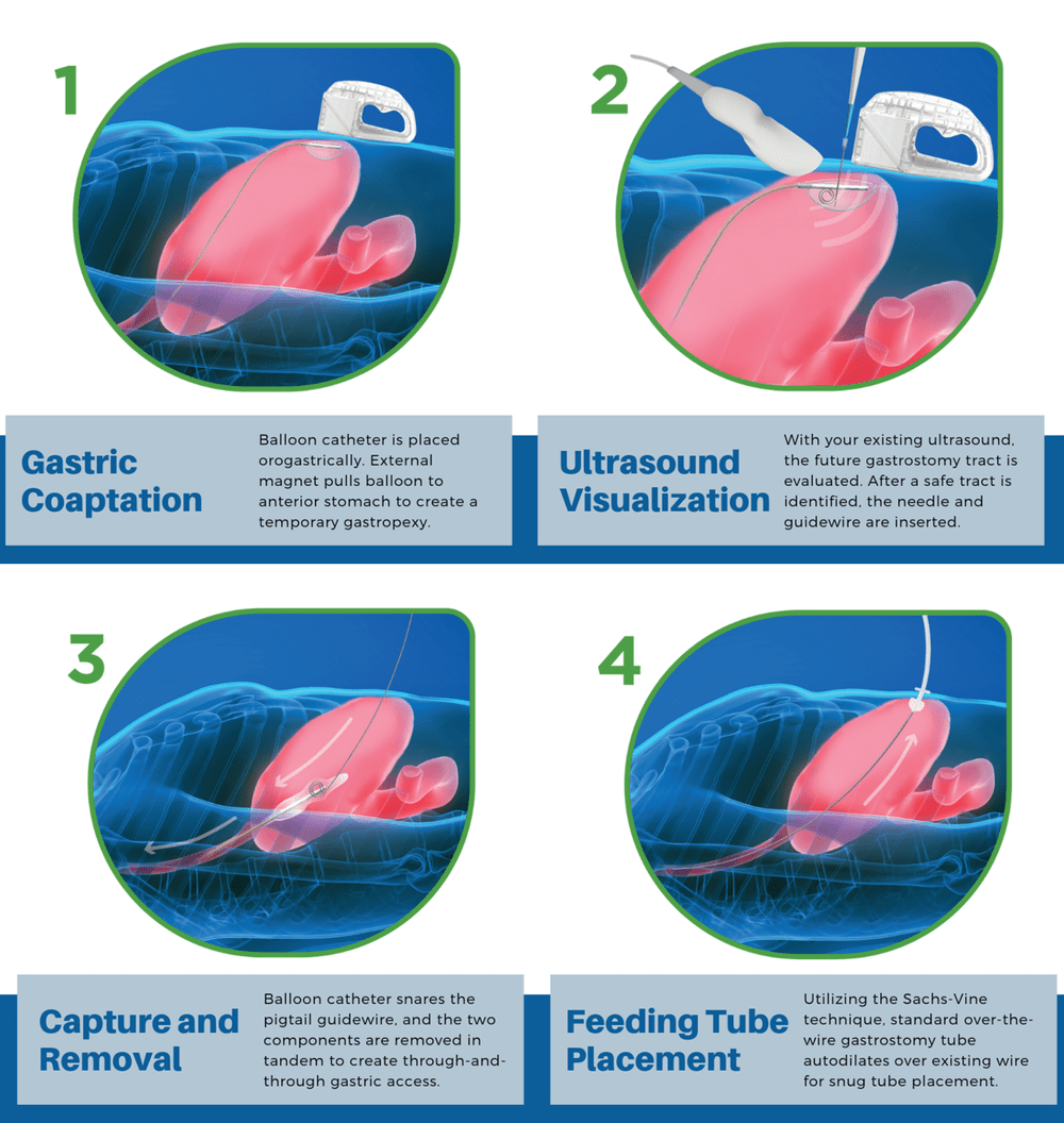 PUMA Ultrasound Gastrostomy — CoapTech | The PUMA-G System | The World ...