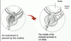 Transurethral prostatectomy (TURP) | Schedule Your Consultation Today ...