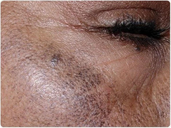 What is hyper-pigmentation and how do you treat it? — Beauty Corner ...