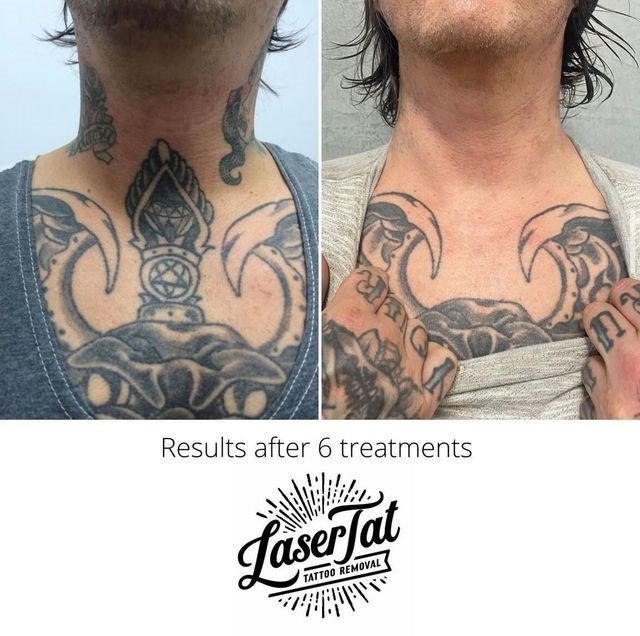 Laser Tattoo Removal: How long until you can see results? — LaserTat