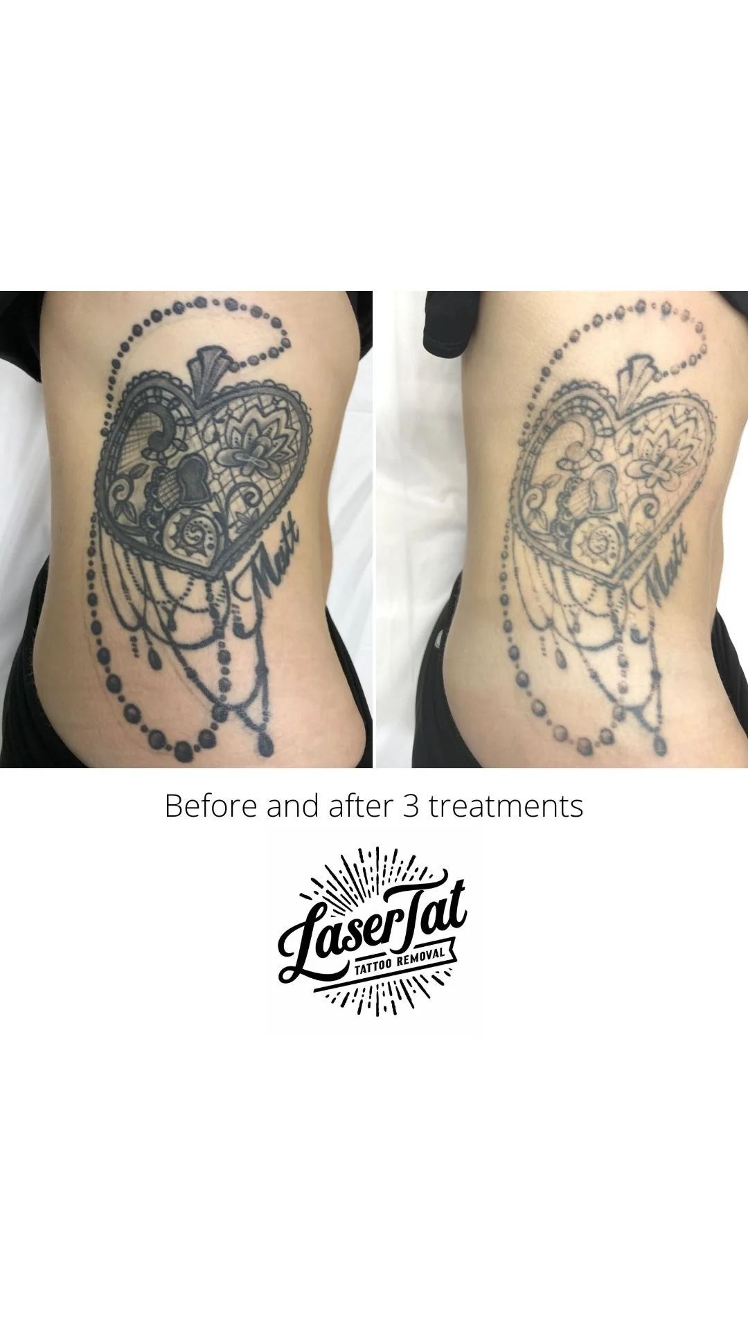 Before & After | Adelaide's Laser Tattoo Removal Experts — LaserTat