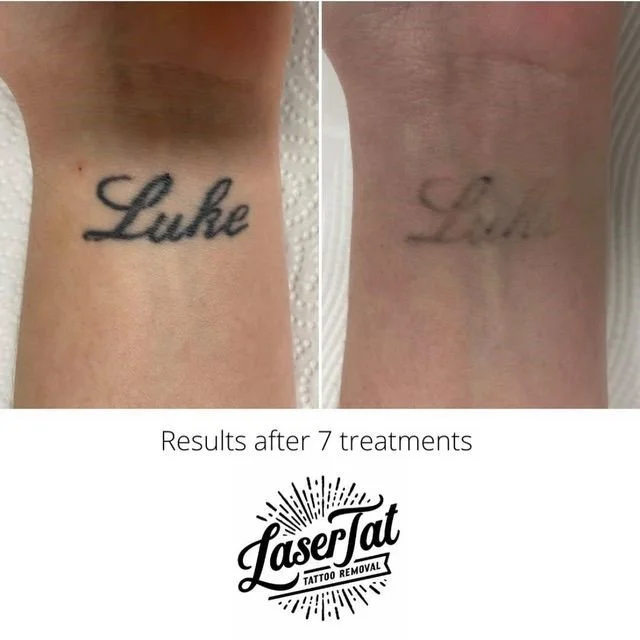 Laser Tattoo Removal: How long until you can see results? — LaserTat