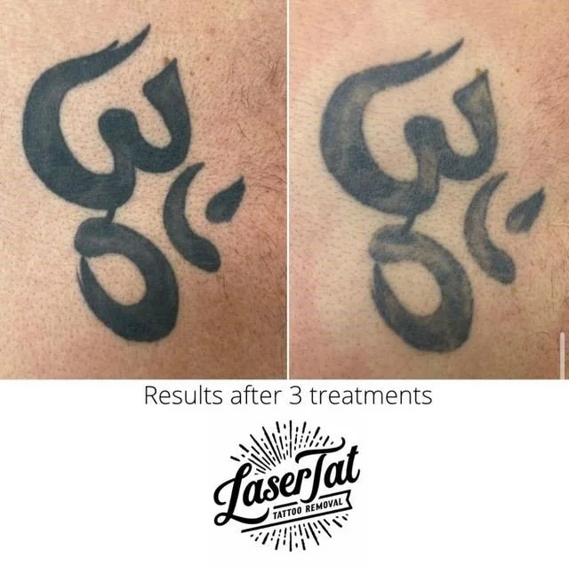 Laser Tattoo Removal: How long until you can see results? — LaserTat