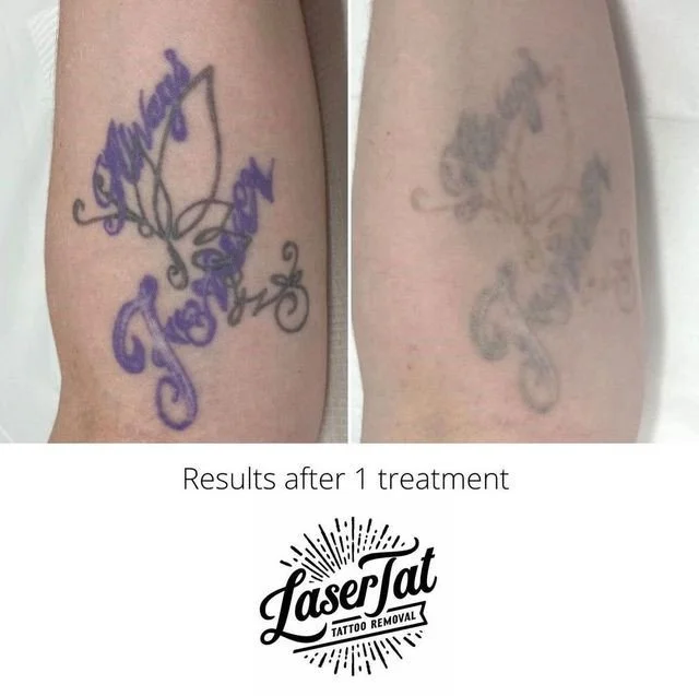 Laser Tattoo Removal: How long until you can see results? — LaserTat